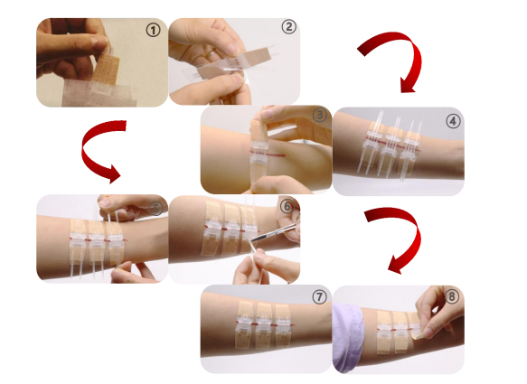 Zipline stitches big size wound closure device for laceration surgery