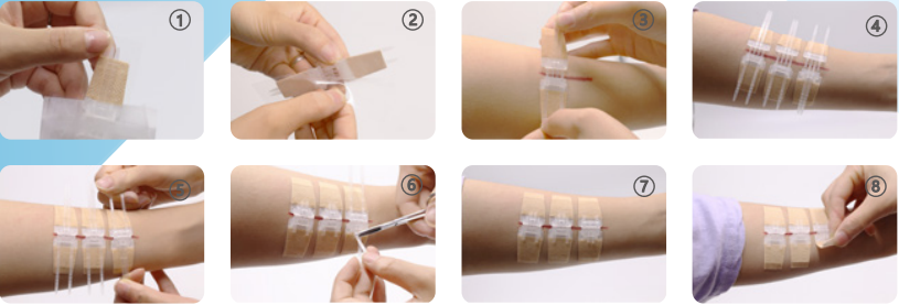 Zipstitch for sale skin closure wound stitch device