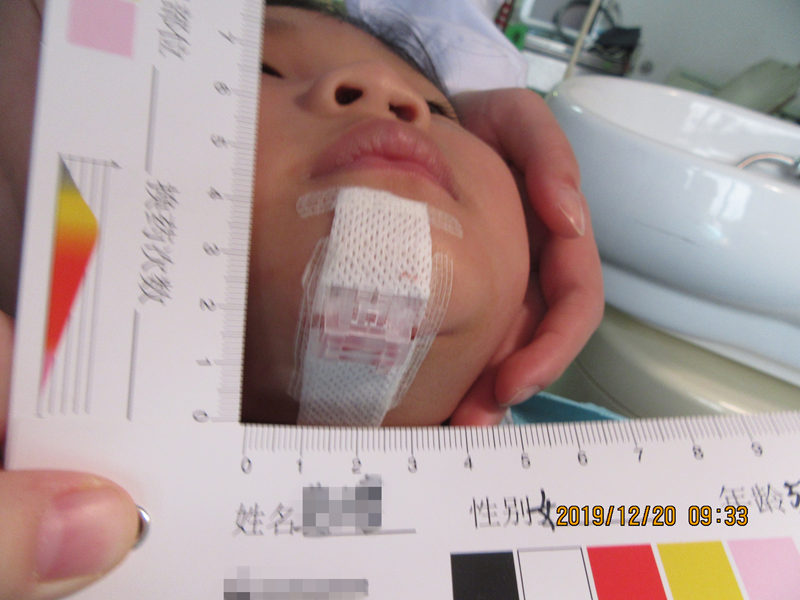 Zipline stitches big size wound closure device for laceration surgery