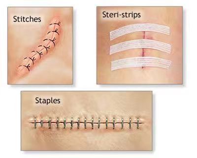 Strip wound closure for wounds medical adhesive steri