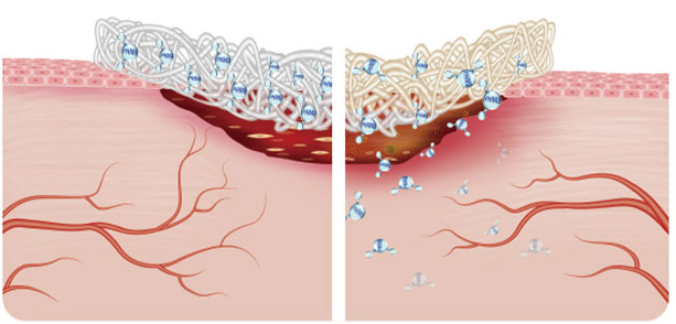 PHMB dressing Antimicrobial Alginate Dressings anti bacteria dressing