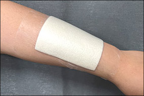 PHMB dressing Antimicrobial Alginate Dressings anti bacteria dressing