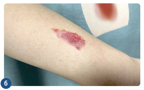 PHMB dressing Antimicrobial Alginate Dressings anti bacteria dressing