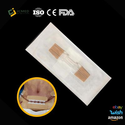 Wound closure without stitches relieves painful of wound suture